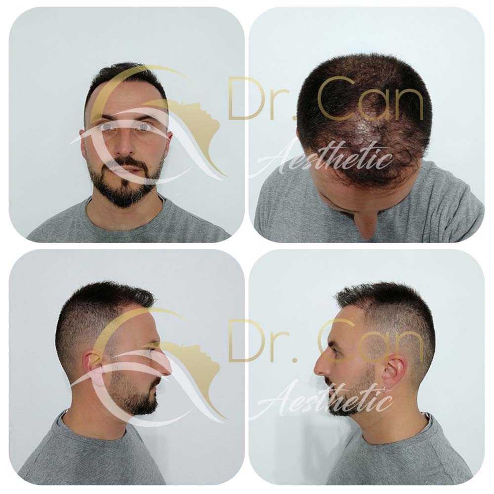 Before - After - Dr Can Esthetic