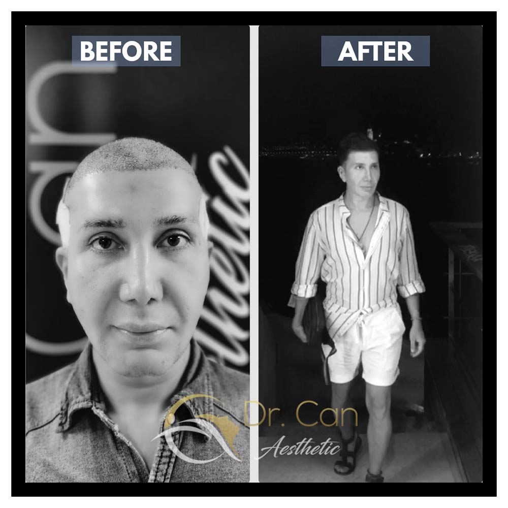 Before - After - Dr Can Esthetic