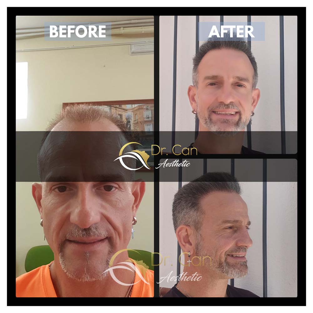 Before - After - Dr Can Esthetic