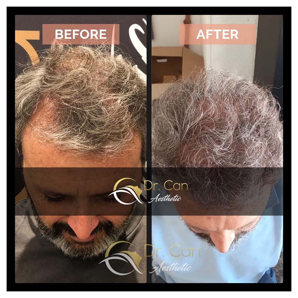 Before - After - Dr Can Esthetic