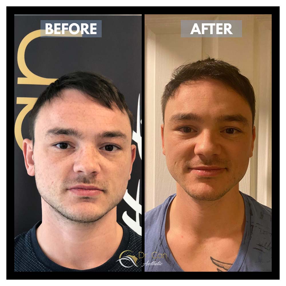Before - After - Dr Can Esthetic
