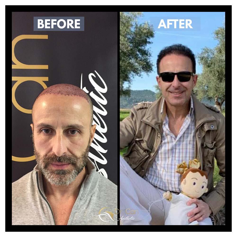 Before - After - Dr Can Esthetic