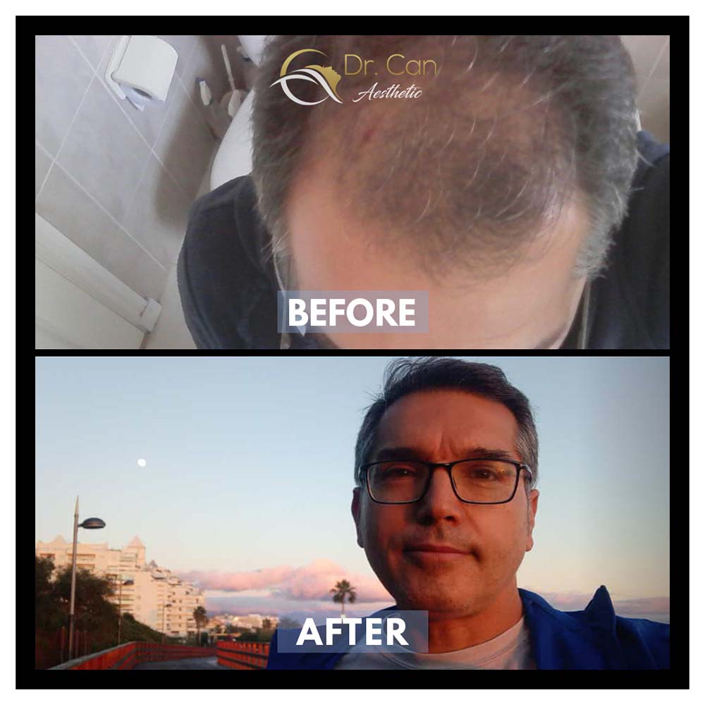 Before - After - Dr Can Esthetic