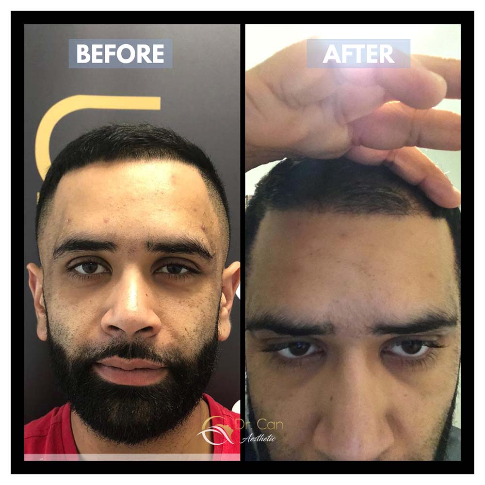 Before - After - Dr Can Esthetic