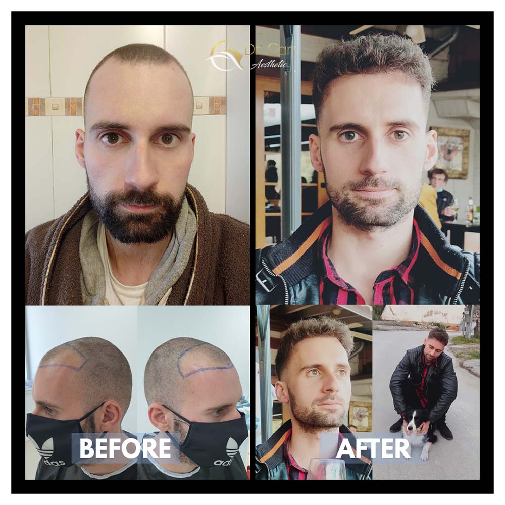 Before - After - Dr Can Esthetic