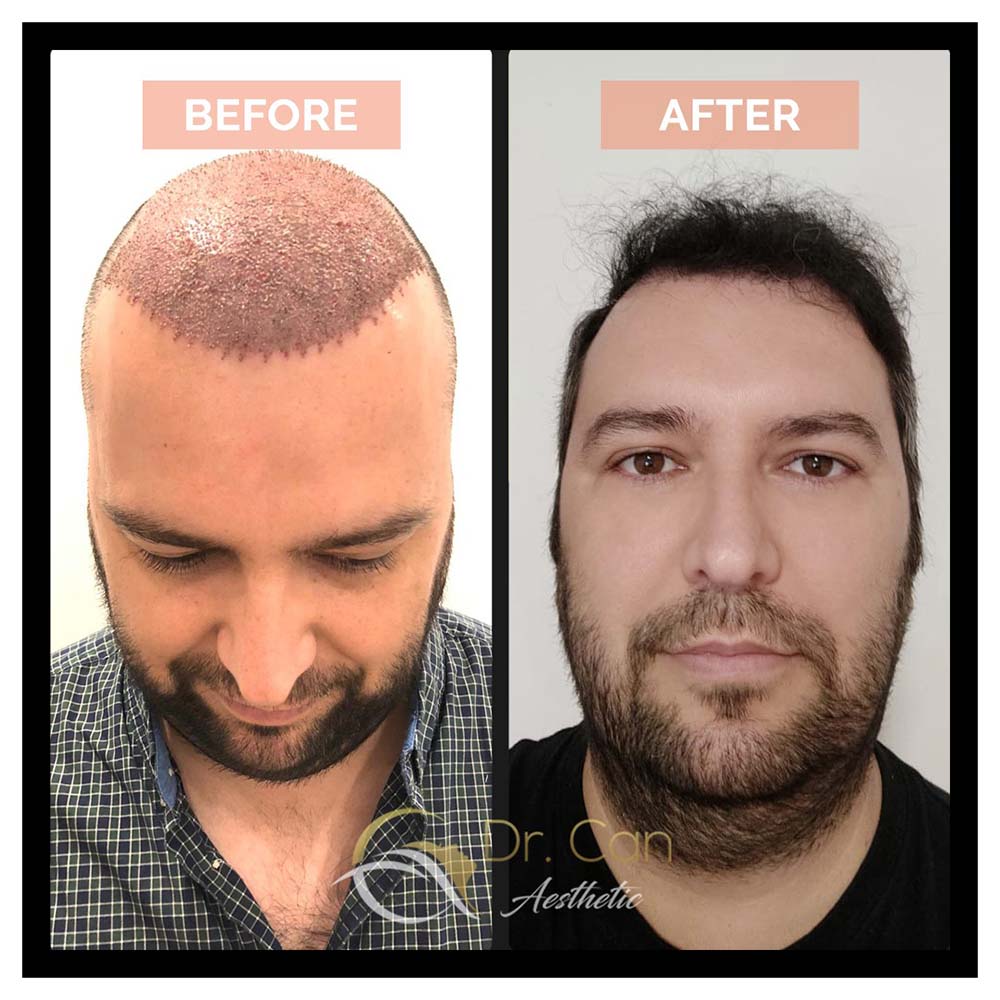 Before - After - Dr Can Esthetic