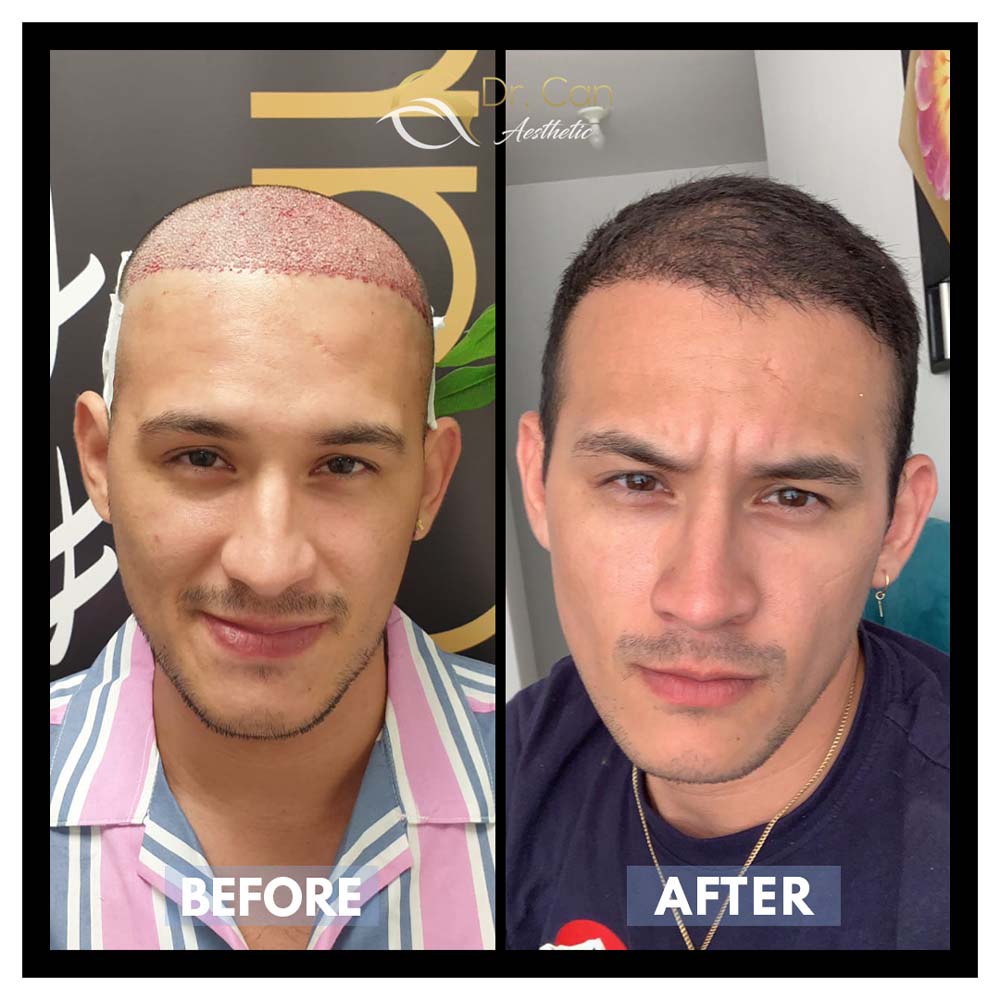 Before - After - Dr Can Esthetic