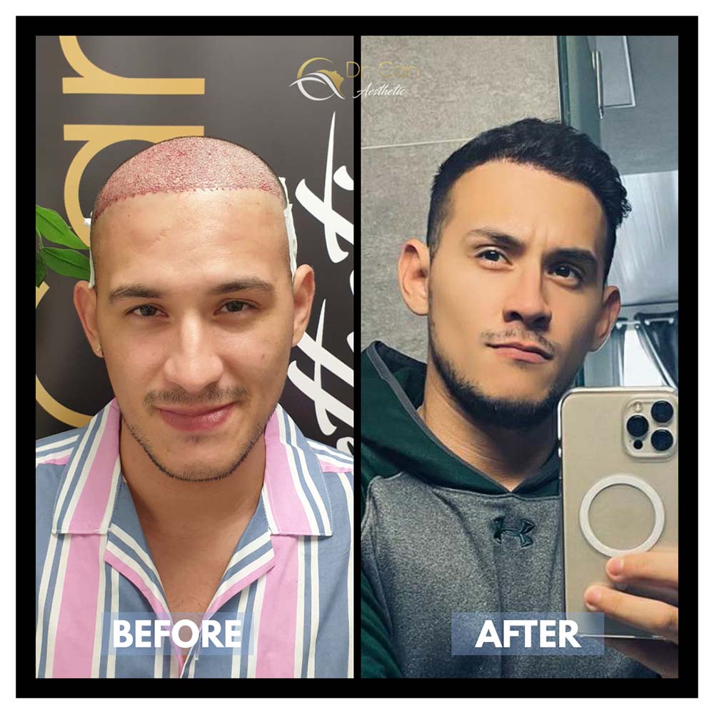 Before - After - Dr Can Esthetic