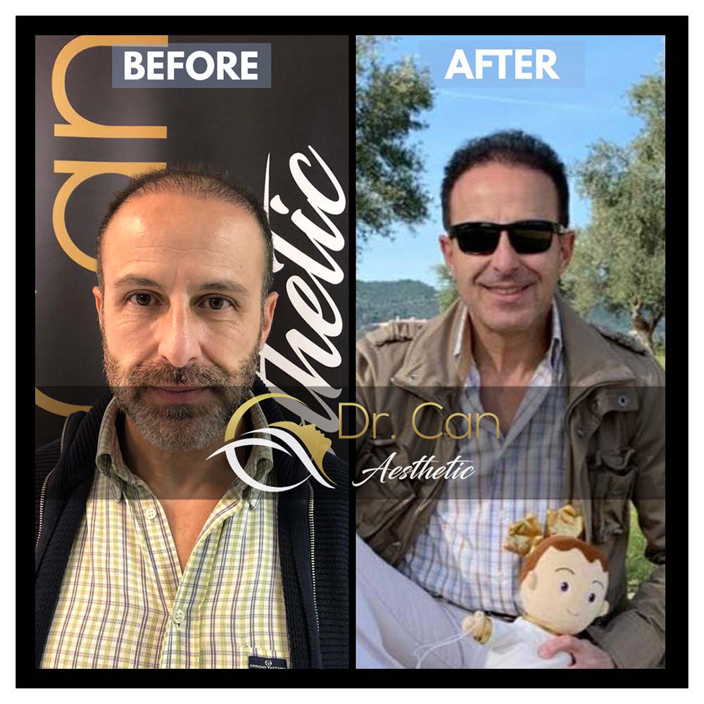Before - After - Dr Can Esthetic