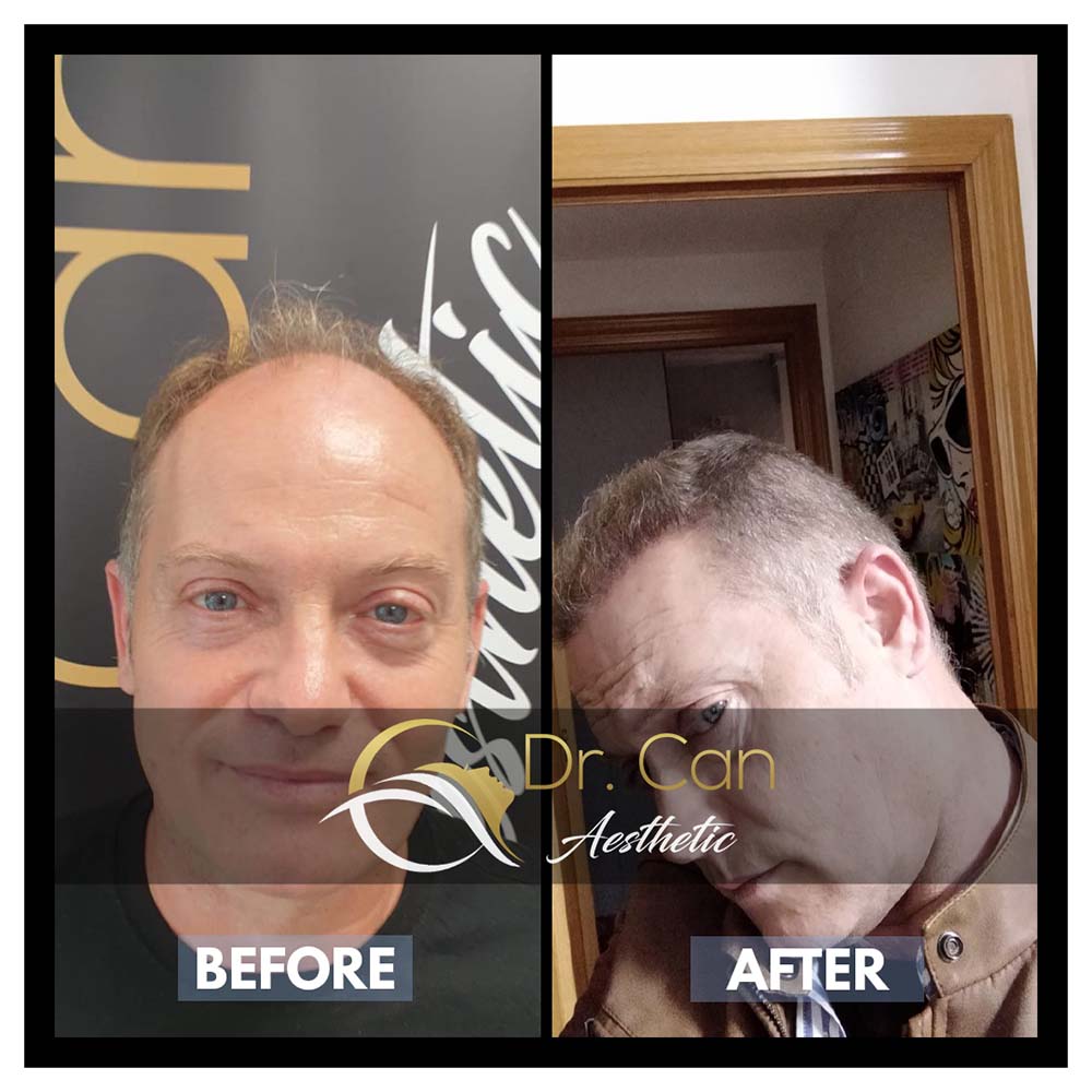 Before - After - Dr Can Esthetic