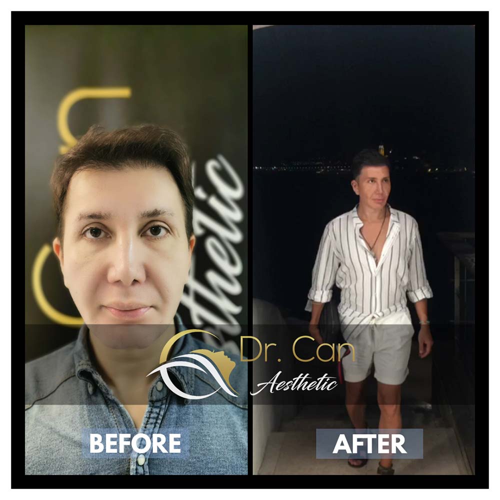 Before - After - Dr Can Esthetic