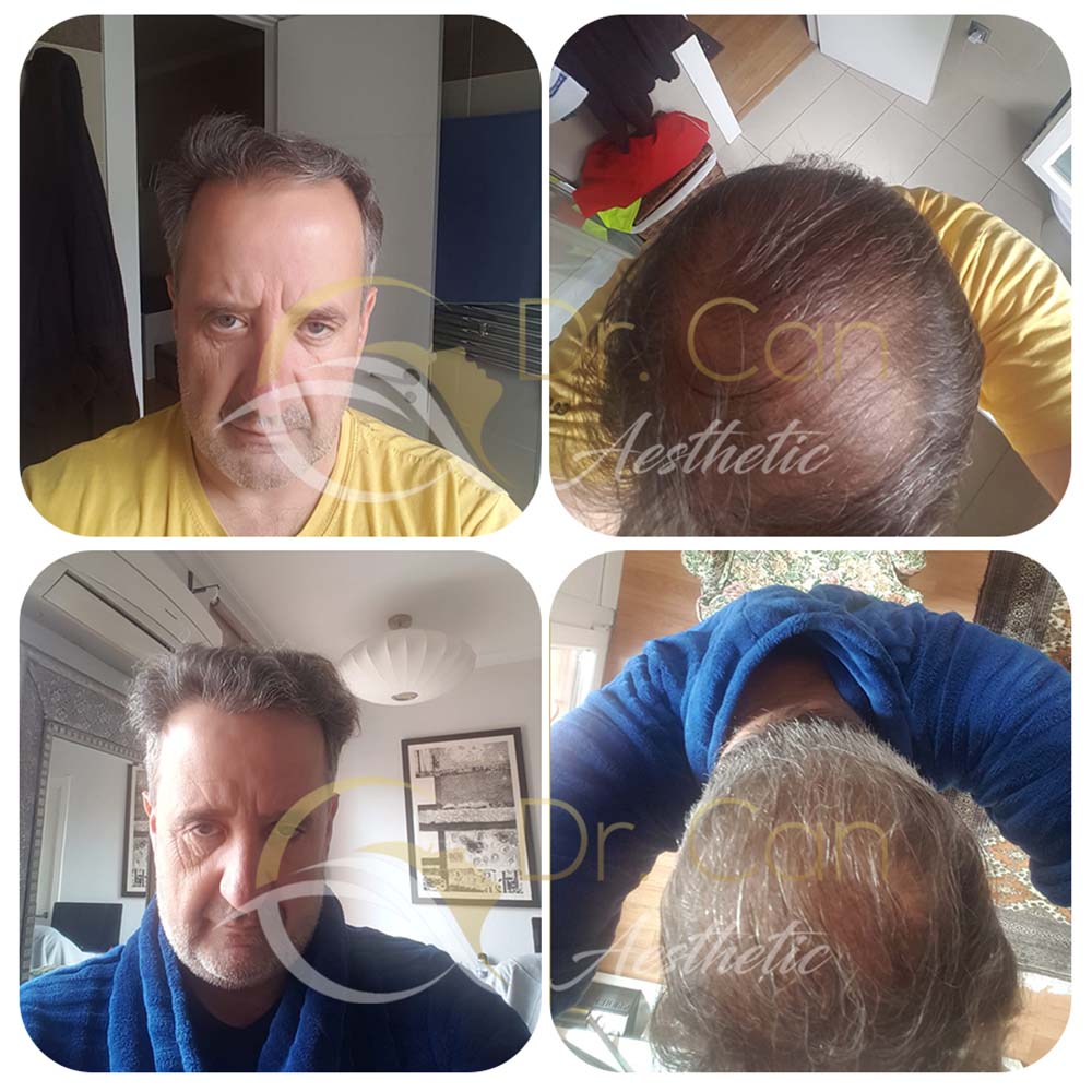 Before - After - Dr Can Esthetic